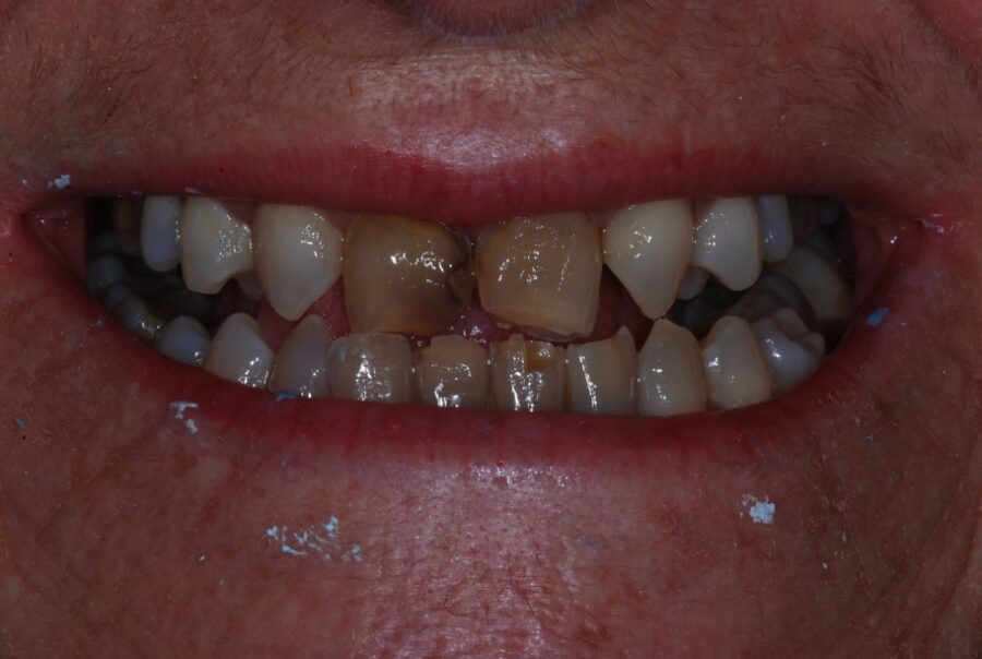 Veneers: Before & After | Thorndon Dental Wellington